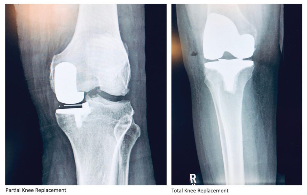 OUTPATIENT PARTIAL KNEE REPLACEMENT Local surgeon utilizes ligament ...