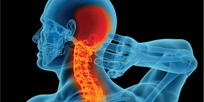 Cervical Instability: A Consideration in Dysautonomia & Joint ...